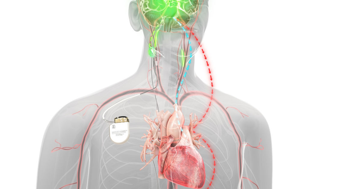 LLUMC – Murrieta now offering baroreflex therapy for patients with ...